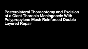 Posterolateral Thoracotomy