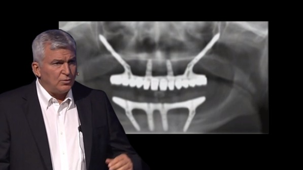 Concept All on 4 Technique