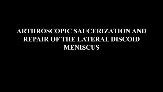 Arthroscopic Saucerization and Repair of the Lateral Discoid Meniscus