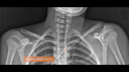 Sternoclavicular Joint Dislocation Management Of Sternoclavicular