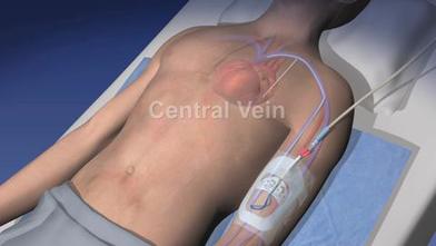 how to draw blood from picc line video