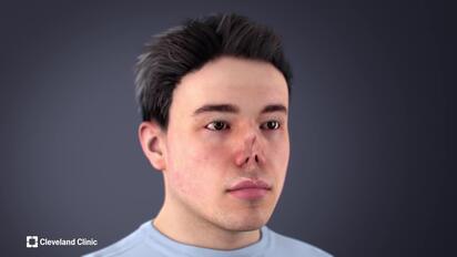 man with missing nose