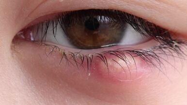 stye lower eyelid outside