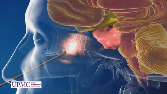 Endoscopic Endonasal Approach (EEA)