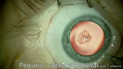 anterior segment surgery