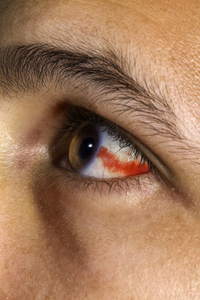 Ophthalmic Artery Rupture Bleeding Eye