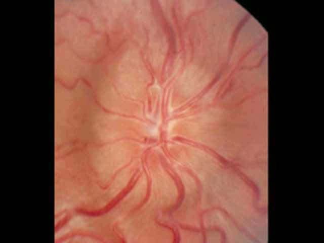 fundoscopy examination