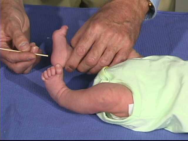 crossed extension reflex test