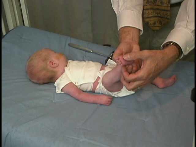 red reflex test newborn