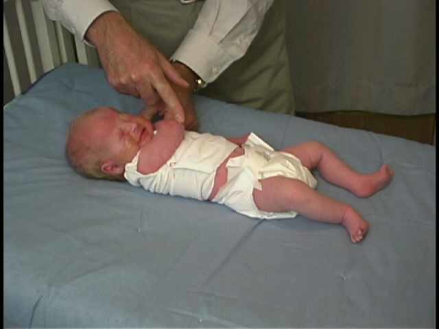 Neurologic Exam-Pediatric | Newborn | Abnormal | Tone - Scarf Sign