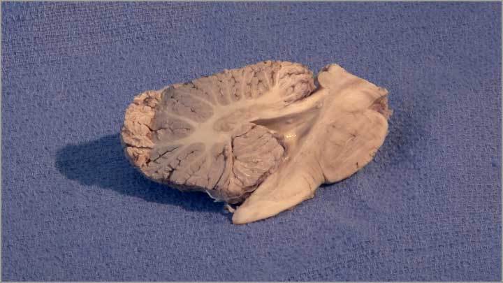 Brain Dissection 09 - Brain Stem & Reflexes